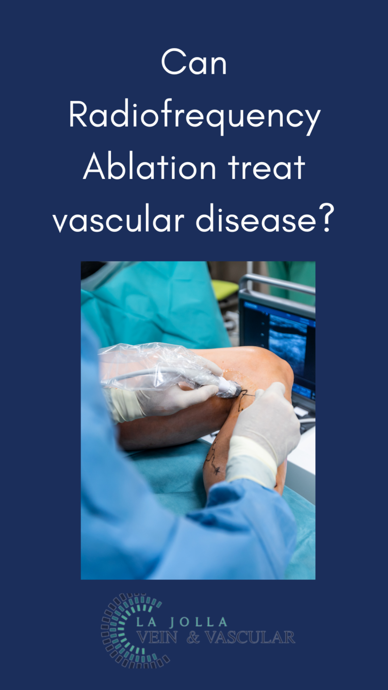 Radiofrequency Ablation Treatment | Vein & Vascular Clinic