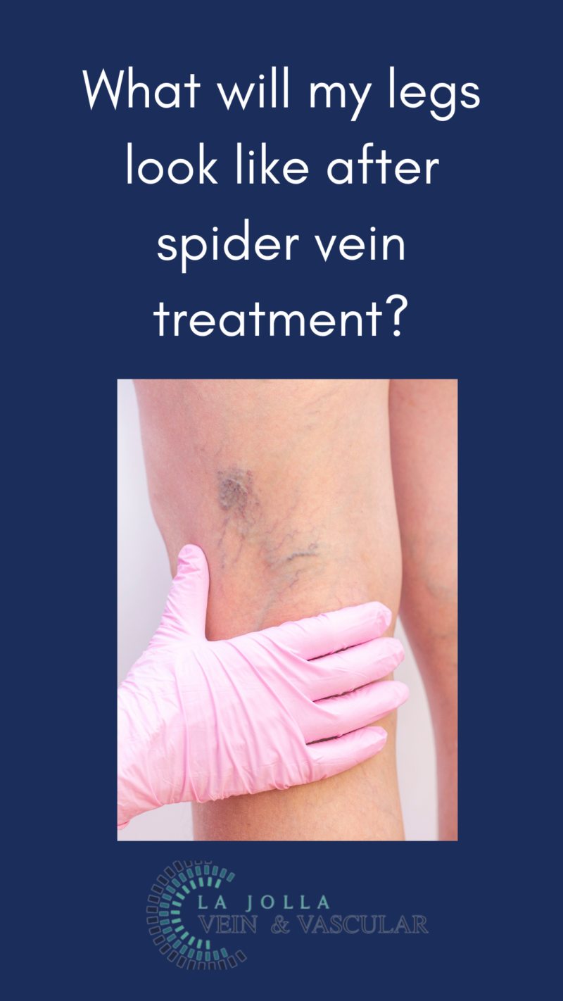 What Will My Legs Look Like After Spider Vein Treatment?