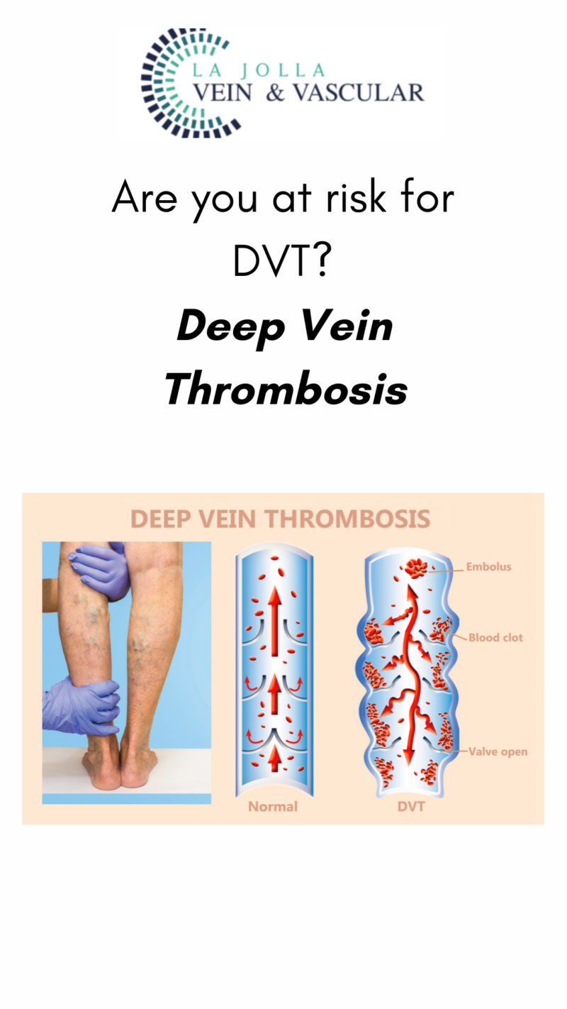 Risk for Deep Venous Thrombosis | Learn DVT Risk Factors