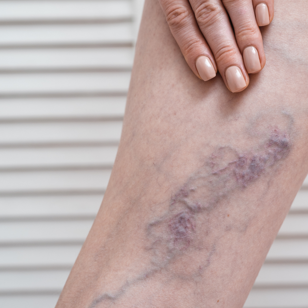 Will My Skin Change with Chronic Venous Insufficiency?