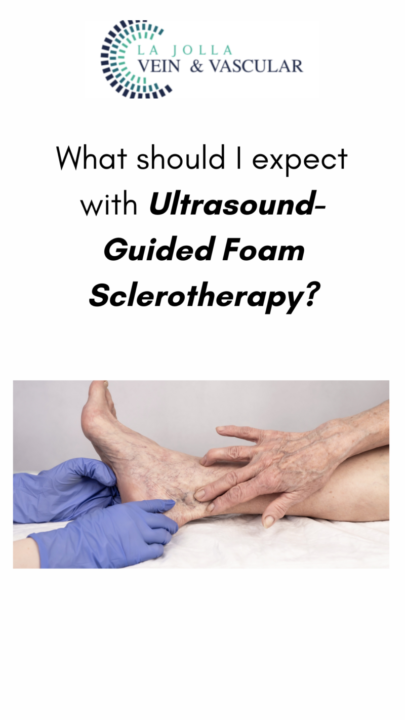 Ultrasound Guided Foam Sclerotherapy La Jolla Vein And Vascular