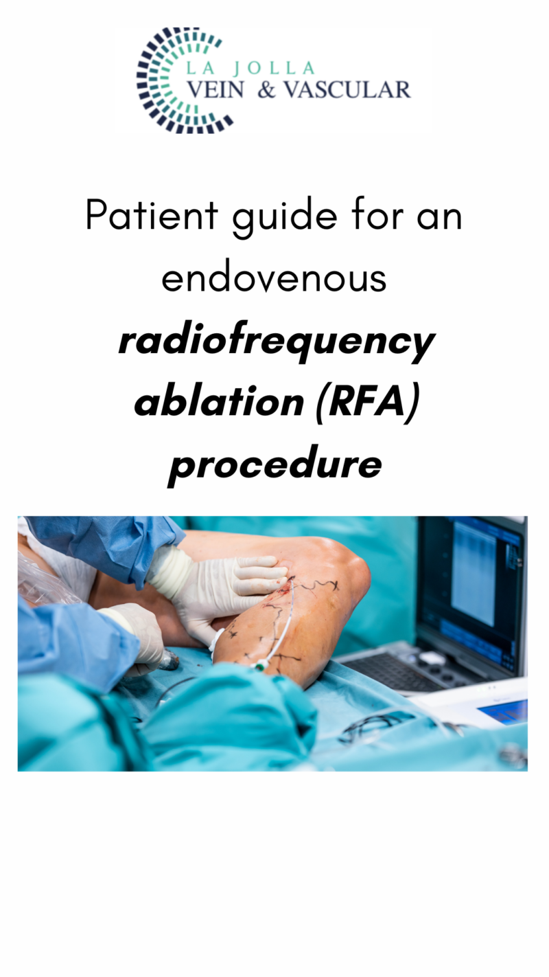 Patient Guide for an Endovenous Radiofrequency Ablation(RFA)