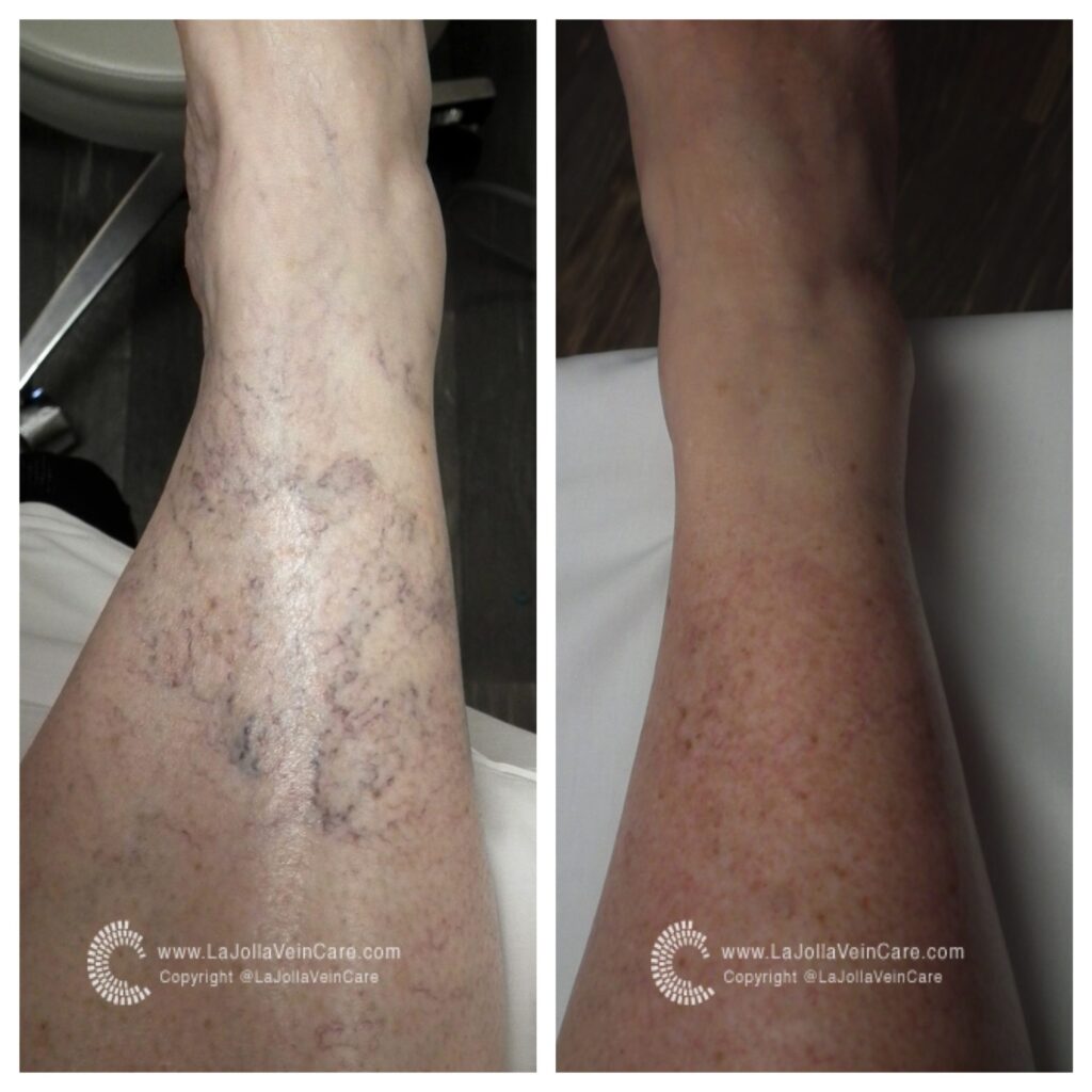 Effective Solutions for Spider Veins: Non-Surgical Treatment