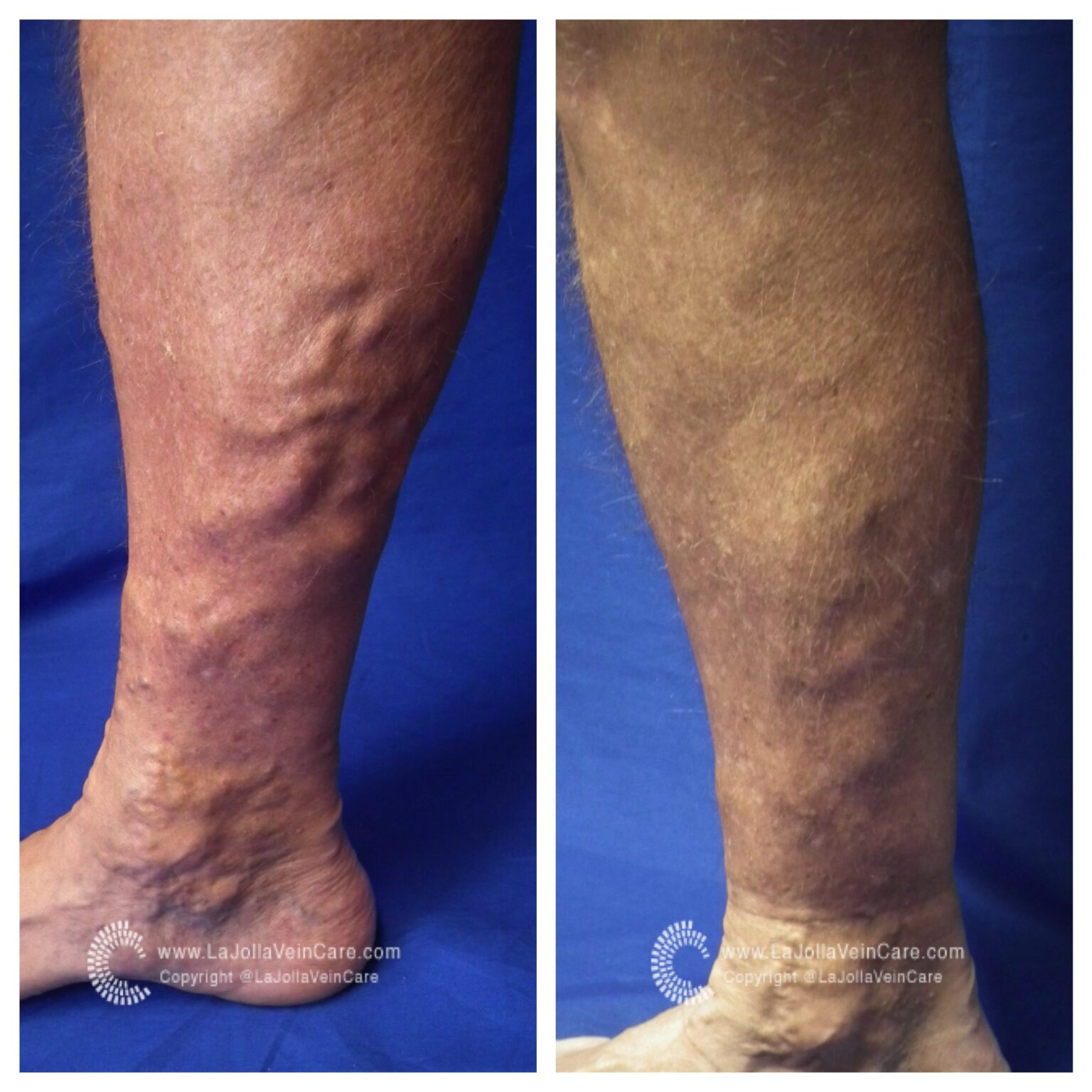 Vein & Vascular Minimally Invasive Treatment | La Jolla