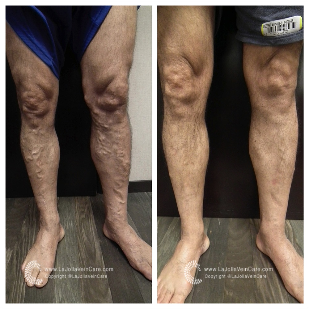 Vein & Vascular Minimally Invasive Treatment | La Jolla